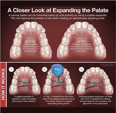 Palatal Expanders for Orthodontic Treatment