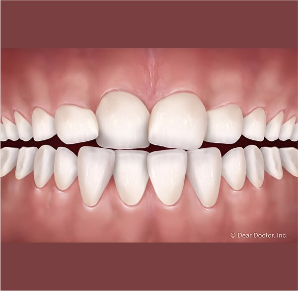 Common Orthodontic Problems & Solutions